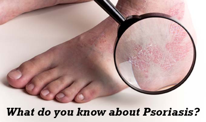 Psoriasis Problem – An Overview - Forum Club